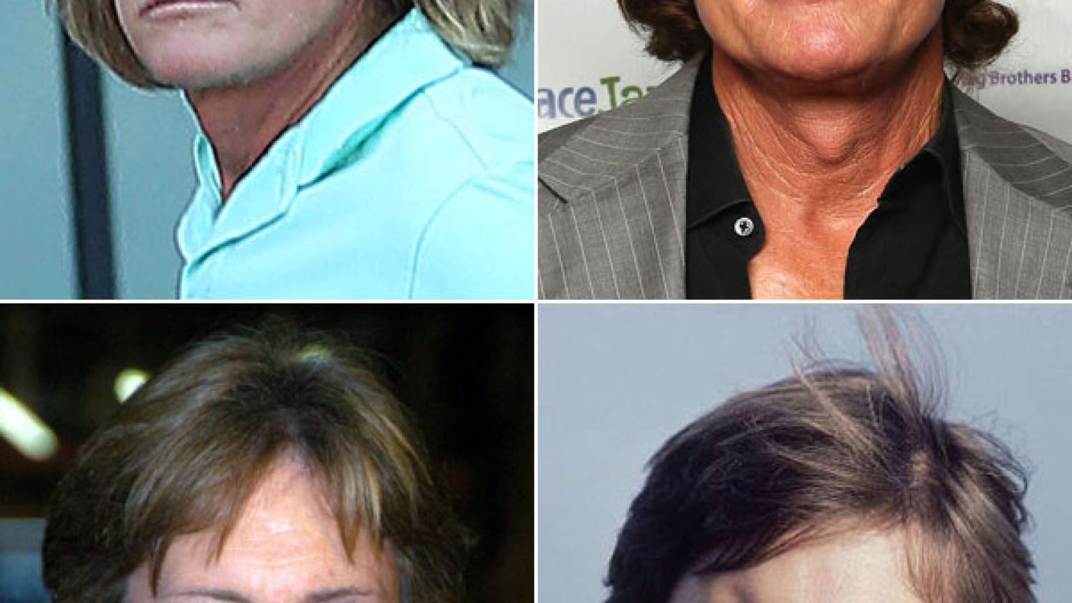 [PICS] Bruce Jenner’s Plastic Surgery — A Scary Facial Transformation ...