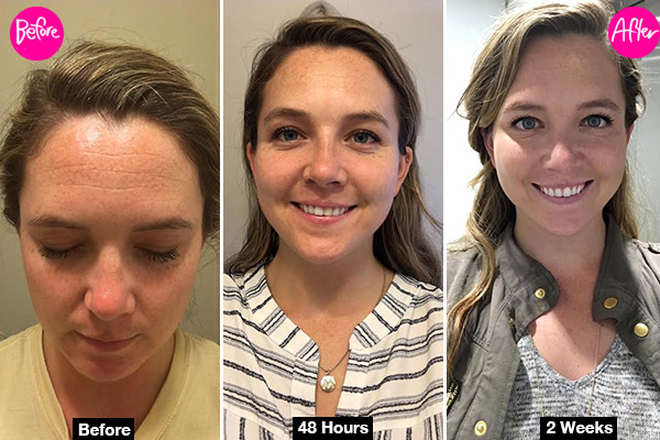 Botox In Your 20s — Why I Got The Treatment At Age 25 – Hollywood Life