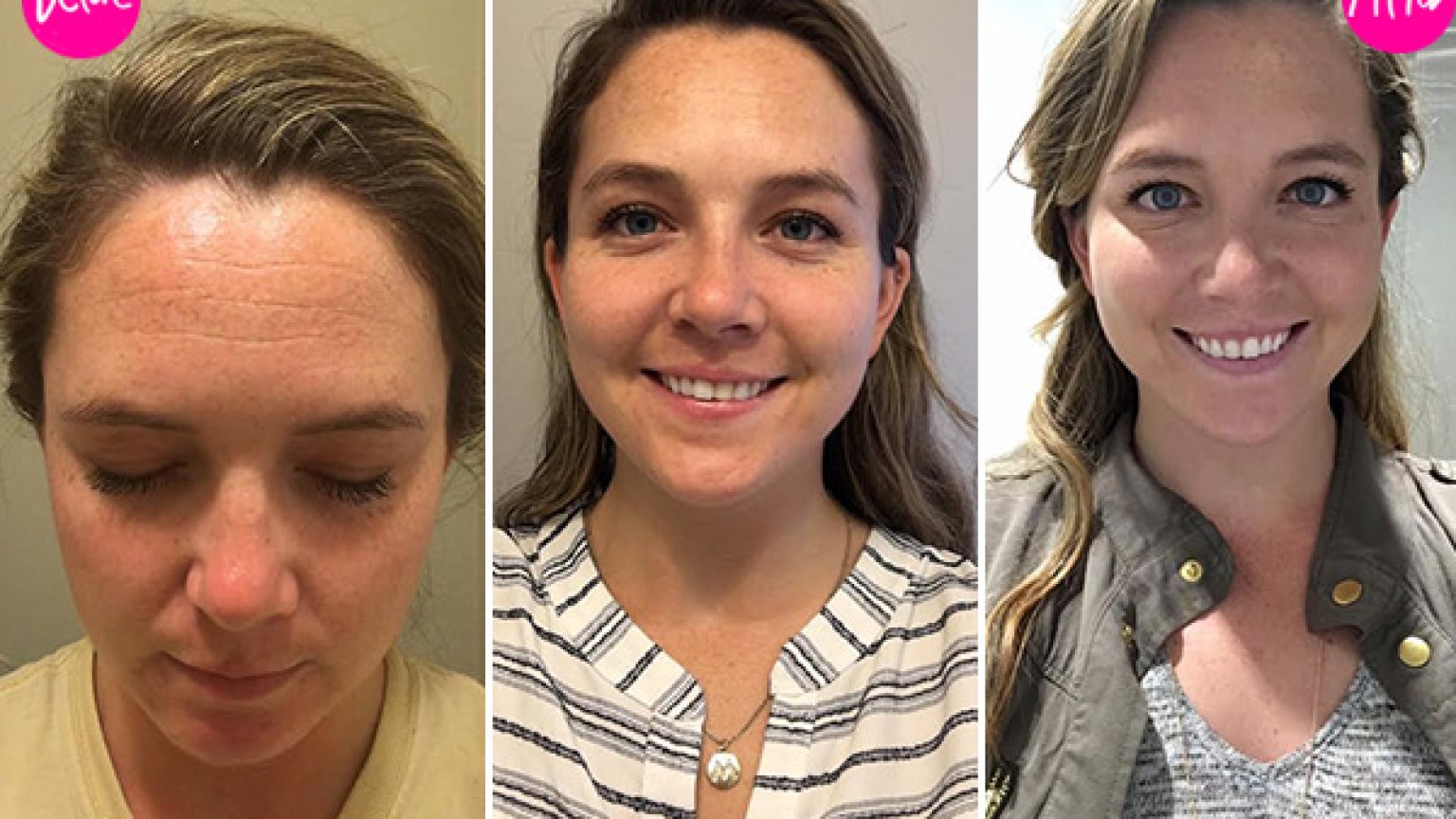 Botox In Your 20s — Why I Got The Treatment At Age 25 – Hollywood Life