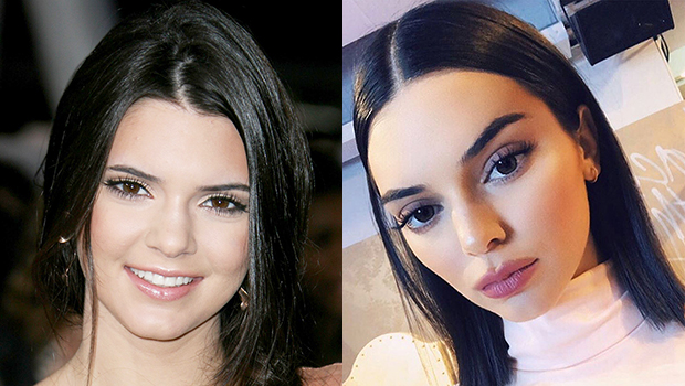 Kendall Jenner’s Lips Over Time: Pics Of Her Pout’s Evolution ...